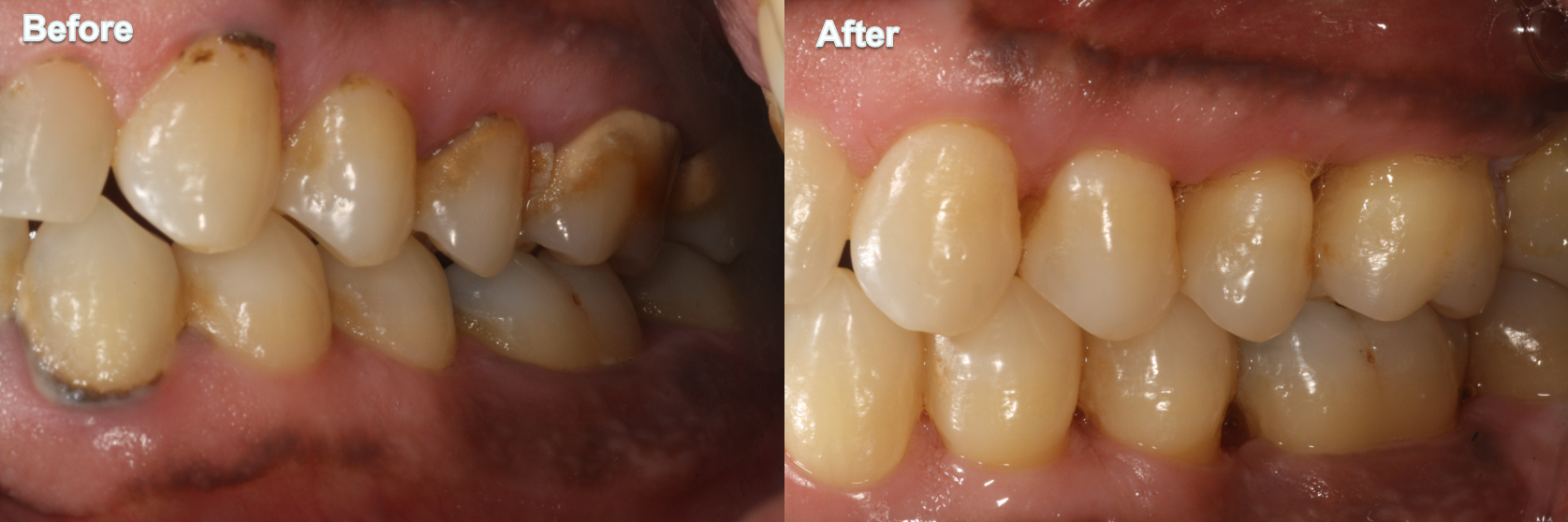 Dental Images Before And After In Indianapolis IN Sonrisa Dental